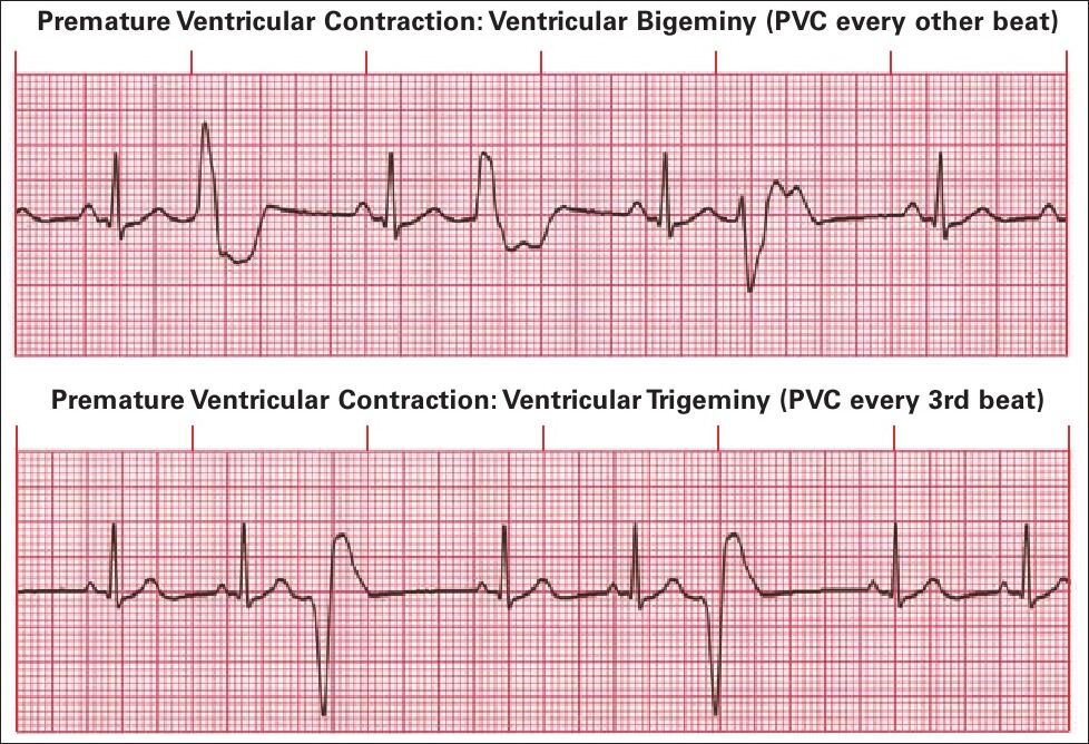 Premature Ventricular Contractions Treatment Cape Town